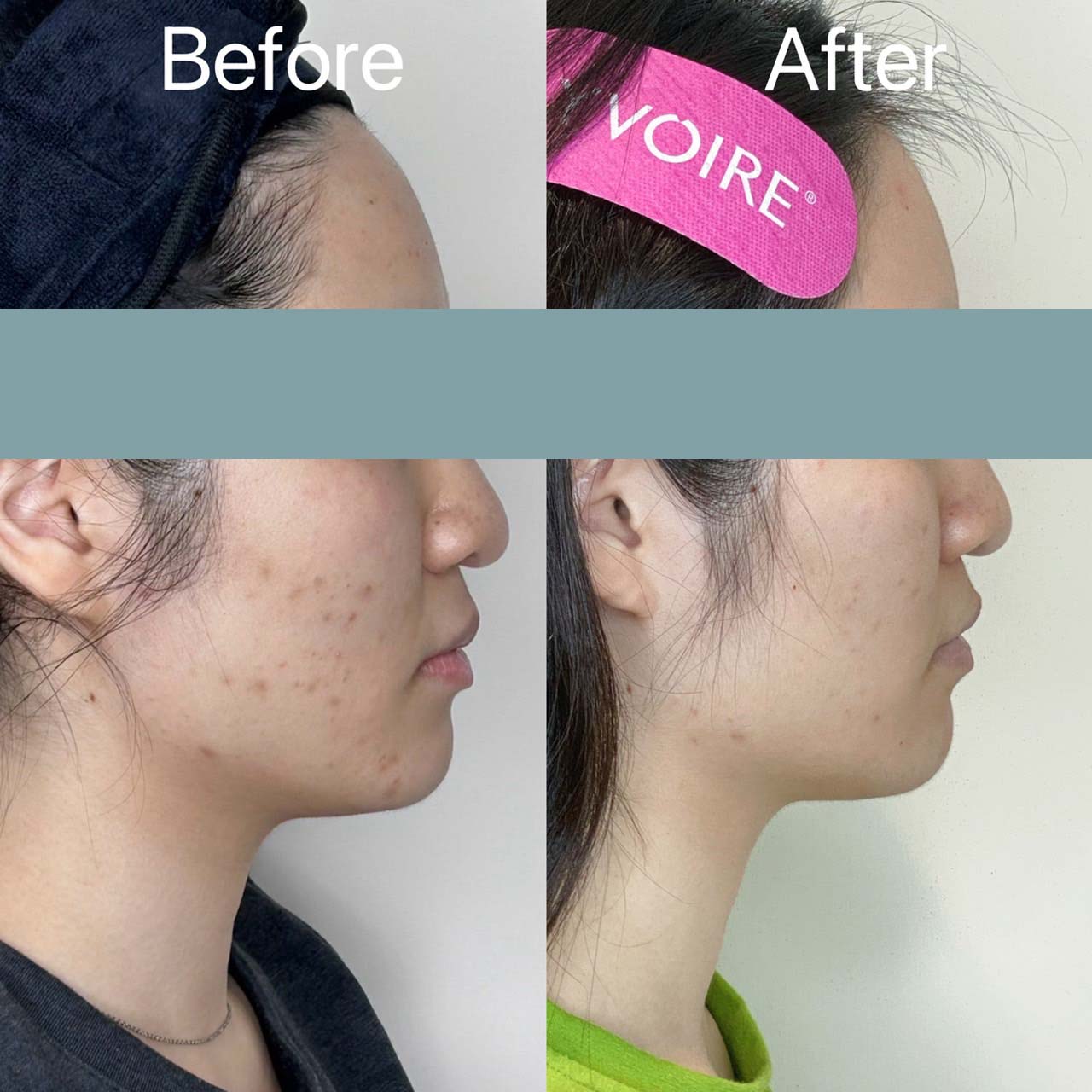 德瑪莎肌膚之光 Derma Shine PRO｜韓星指定療程，煥采肌光的水光針新選擇！