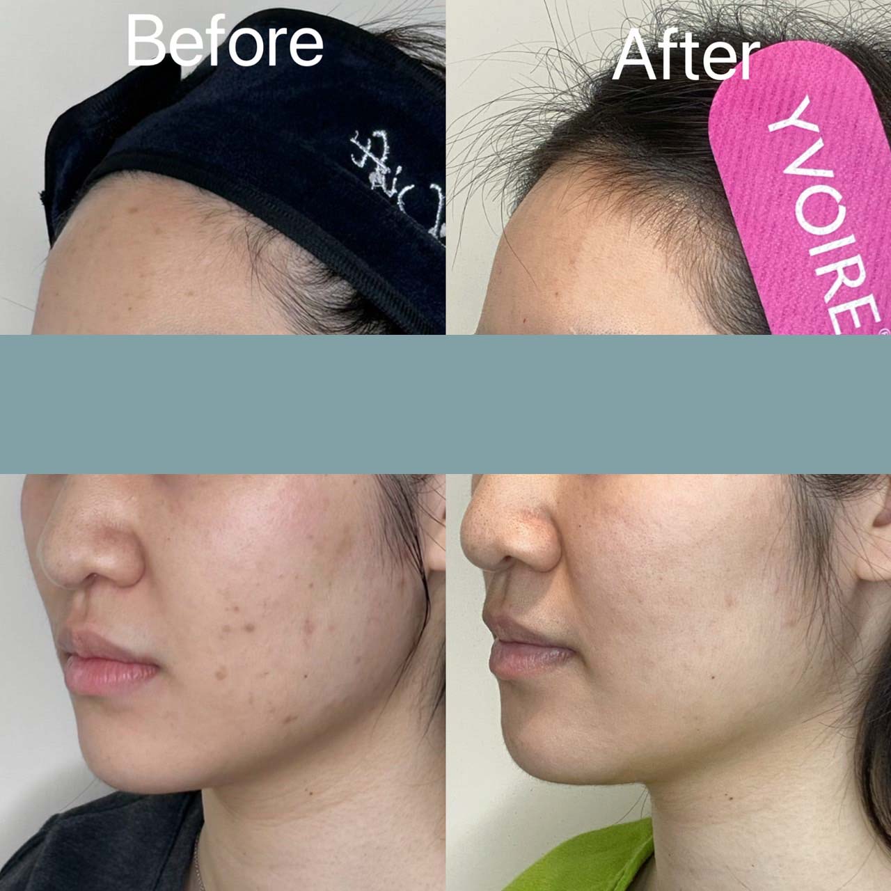 德瑪莎肌膚之光 Derma Shine PRO｜韓星指定療程，煥采肌光的水光針新選擇！